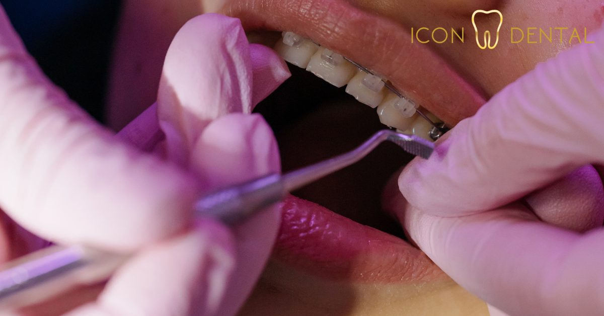 Braces Price: Straighten Teeth Cost Braces Price: Straighten Teeth Cost
