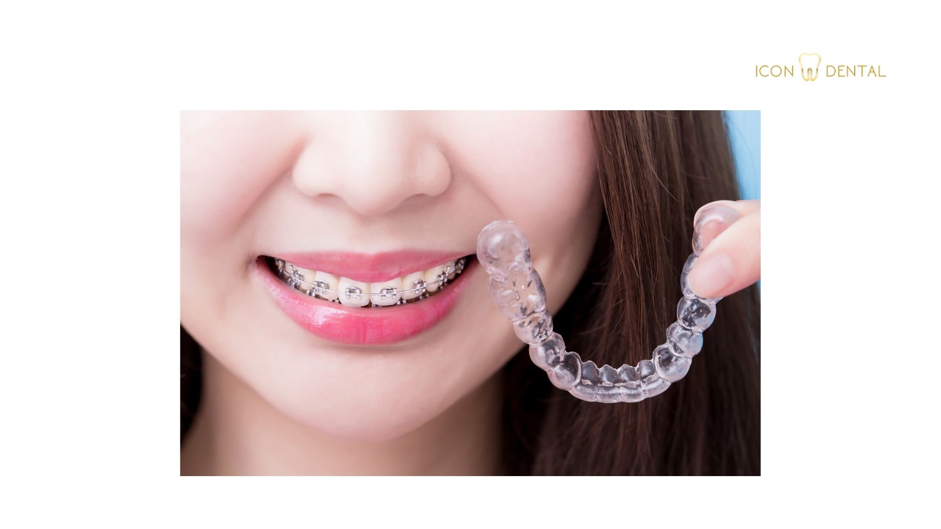 Braces Vs Invisalign I Platinum Elite Provider - Icon Dental