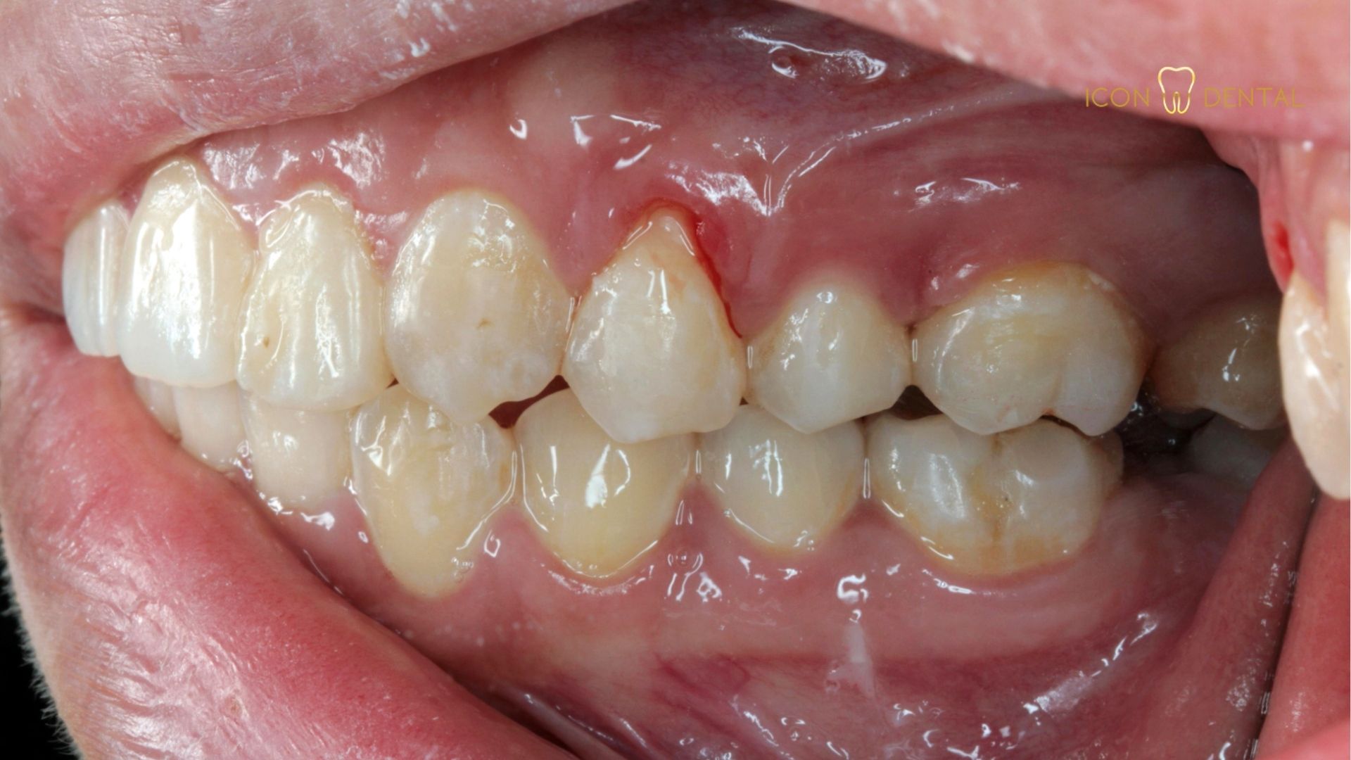 The Early Signs of Receding Gums and Preventive Measures