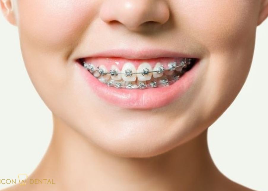 Do Braces Change Your Face Shape? I Braces Price Selangor